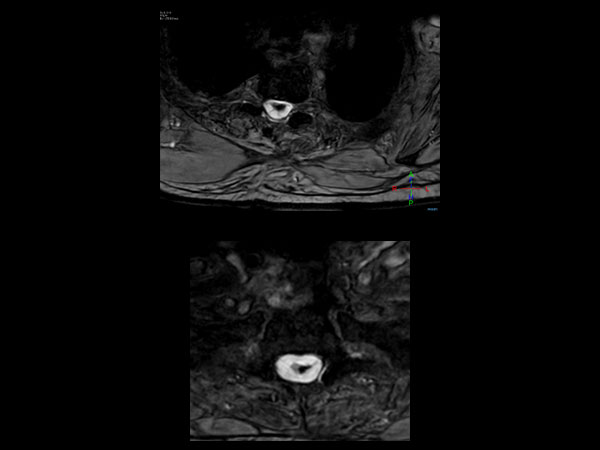 Post Surgery Cervical Spine Philips Mr Body Map