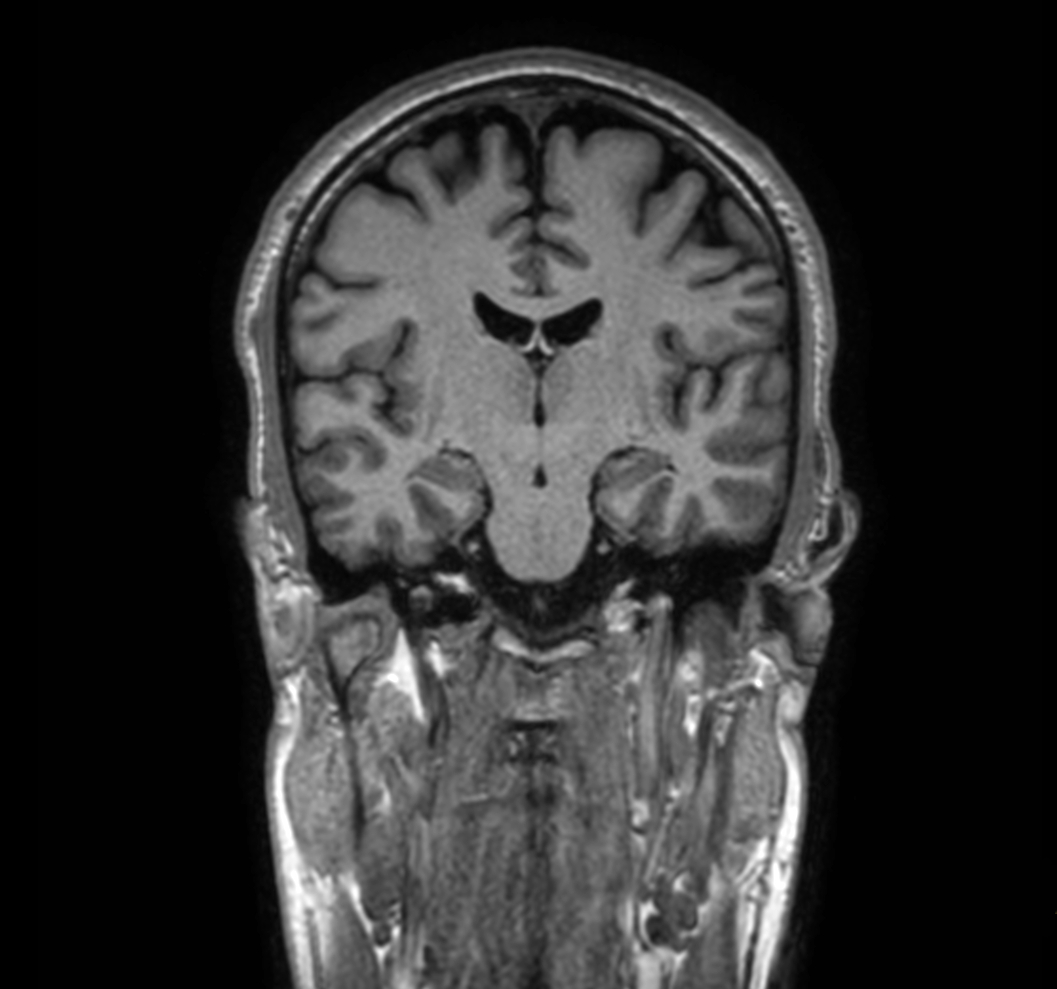 Brain imaging with noise reduction | Philips MR Body Map