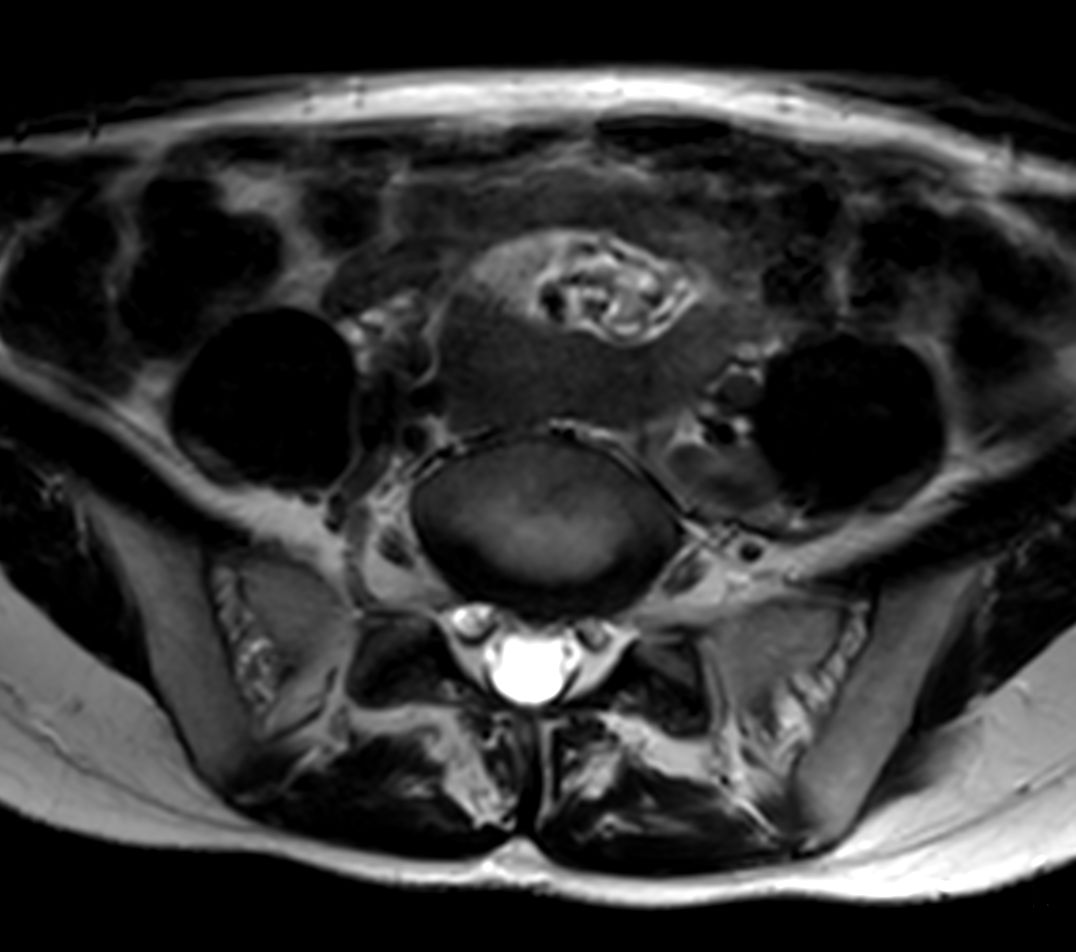 Lumbar Plexus Imaging Philips Mr Body Map