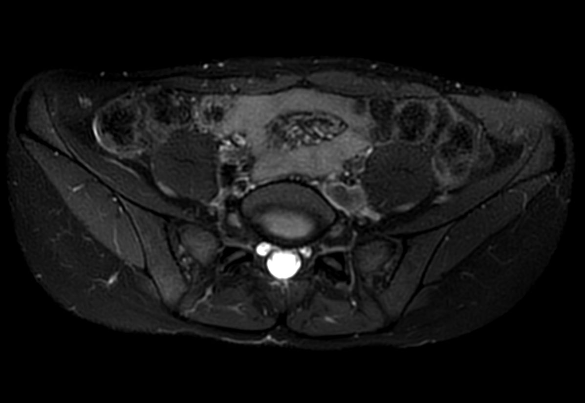 Lumbar Plexus Imaging Philips Mr Body Map