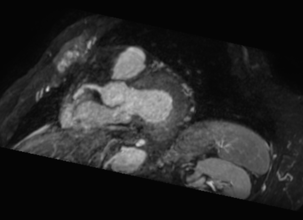 Acute Myocardial Infarction Philips Mr Body Map