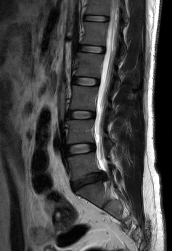 Lumbar Spine Stenosis With Compressed Sense Philips Mr Body Map