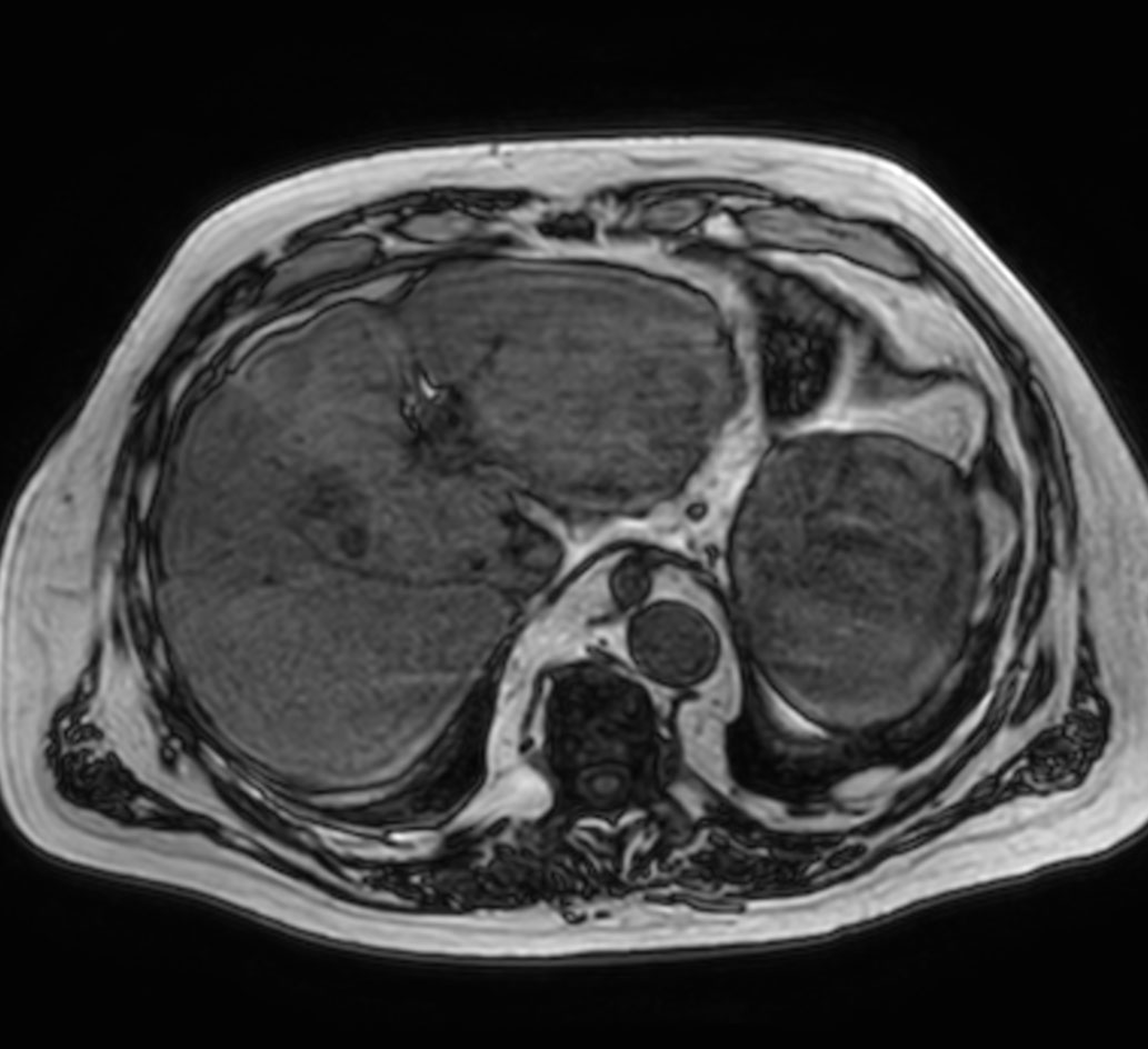 What Is A Mri With Mrcp At Rebecca Skinner Blog
