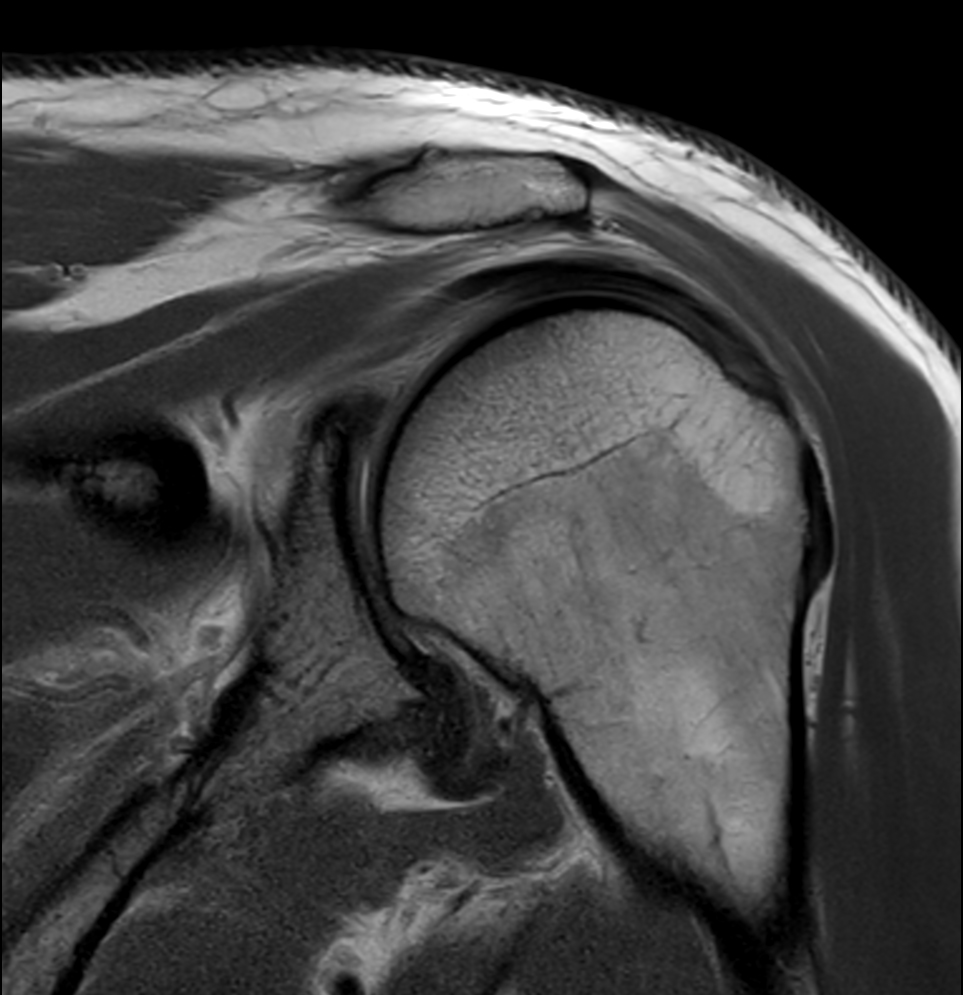 Shoulder imaging with the dS 16ch Shoulder coil | Philips MR Body Map