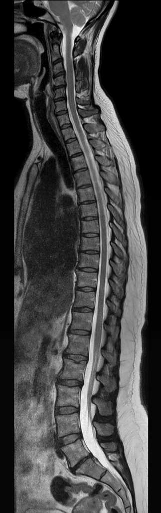 Helium Free Mr Operations Total Spine On Blueseal Magnet Philips Mr