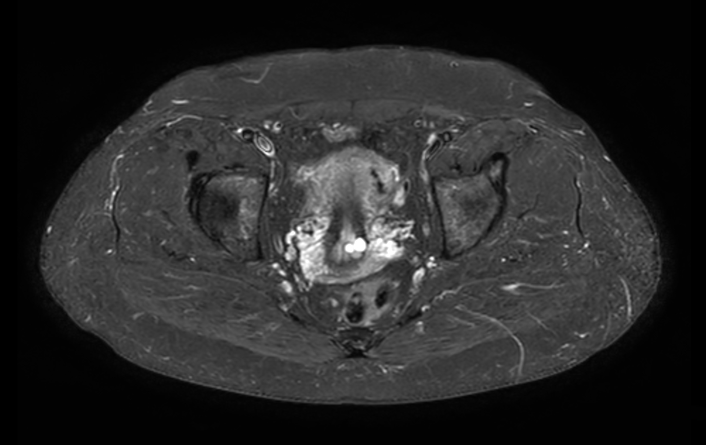 Helium Free Mr Operations Female Pelvis On Blueseal Magnet Philips
