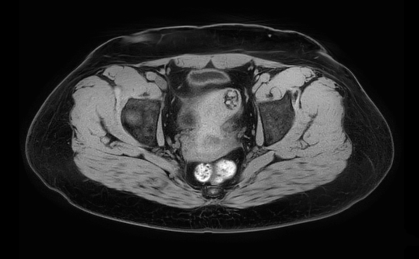 Helium Free Mr Operations Female Pelvis On Blueseal Magnet Philips