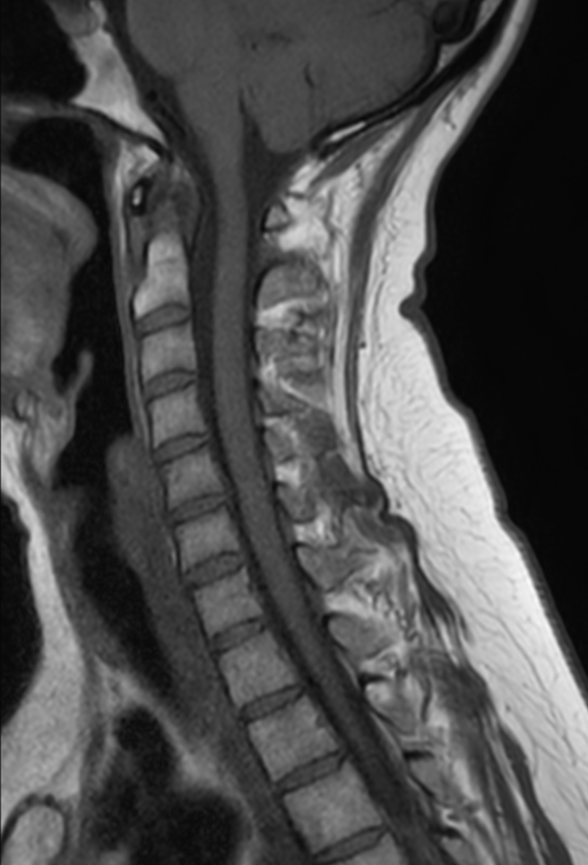 Helium Free Mr Operations Cervical Spine On Blueseal Magnet Philips