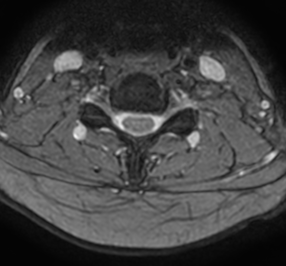 Helium Free Mr Operations Cervical Spine On Blueseal Magnet Philips