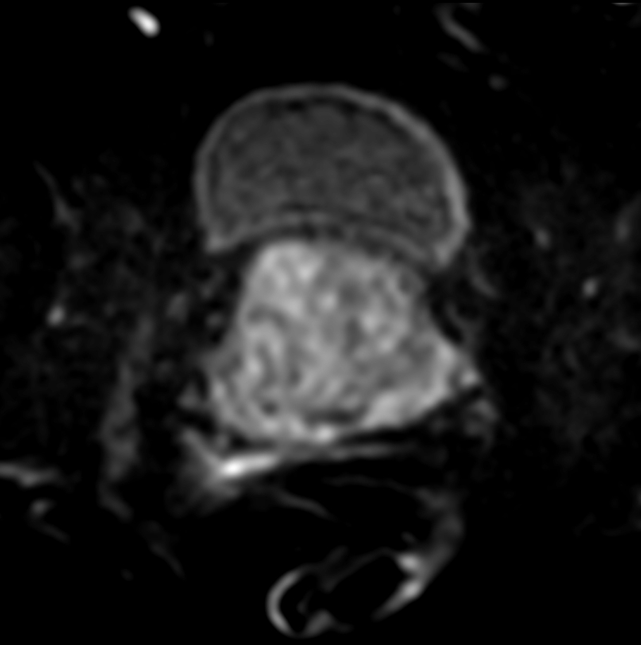 Compressed Sense Prostate Imaging Philips Mr Body Map