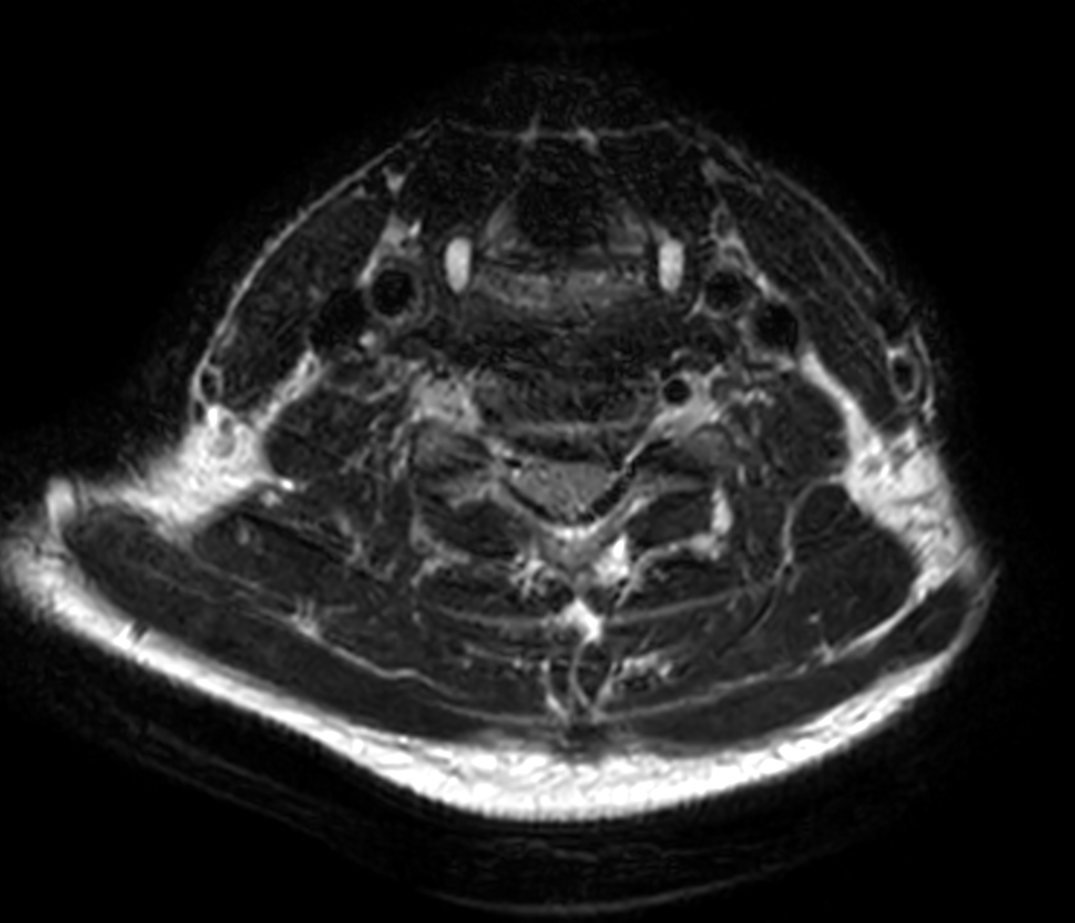 Shorten Exam Time With Compressed Sense In Cervical Spine Philips Mr