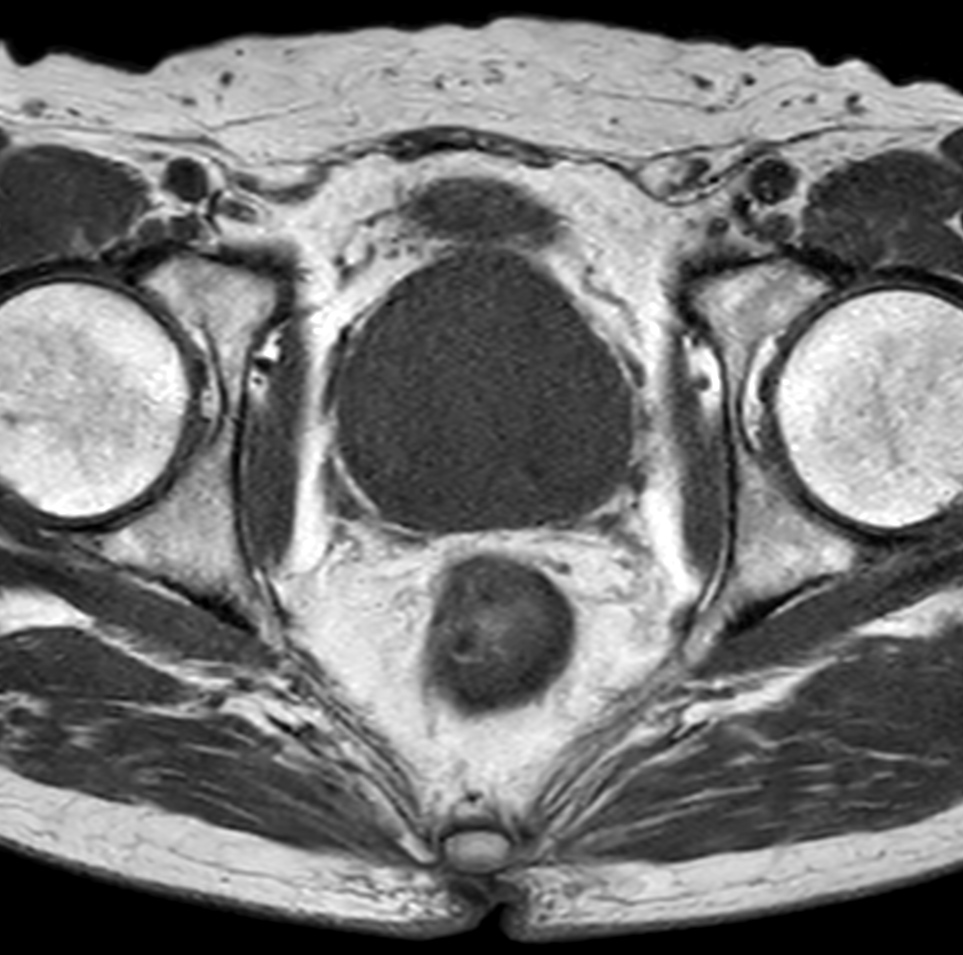 Multi Phase Contrast Enhanced Prostate Imaging Philips Mr Body Map