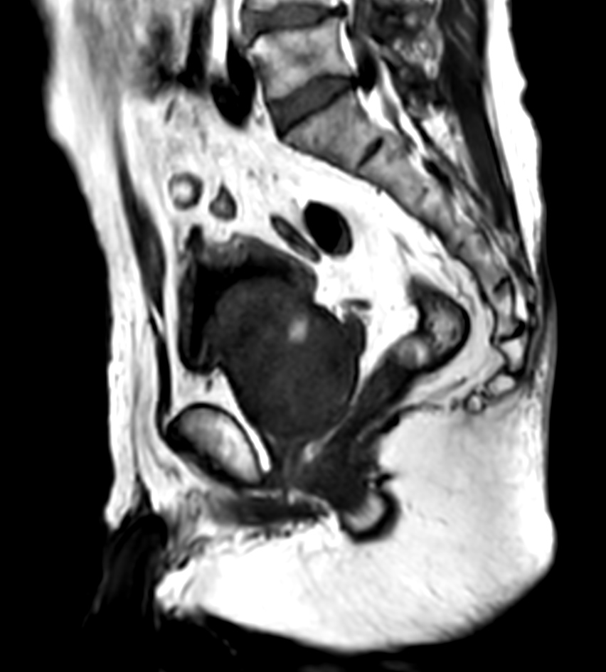 Multi Phase Contrast Enhanced Prostate Imaging Philips Mr Body Map