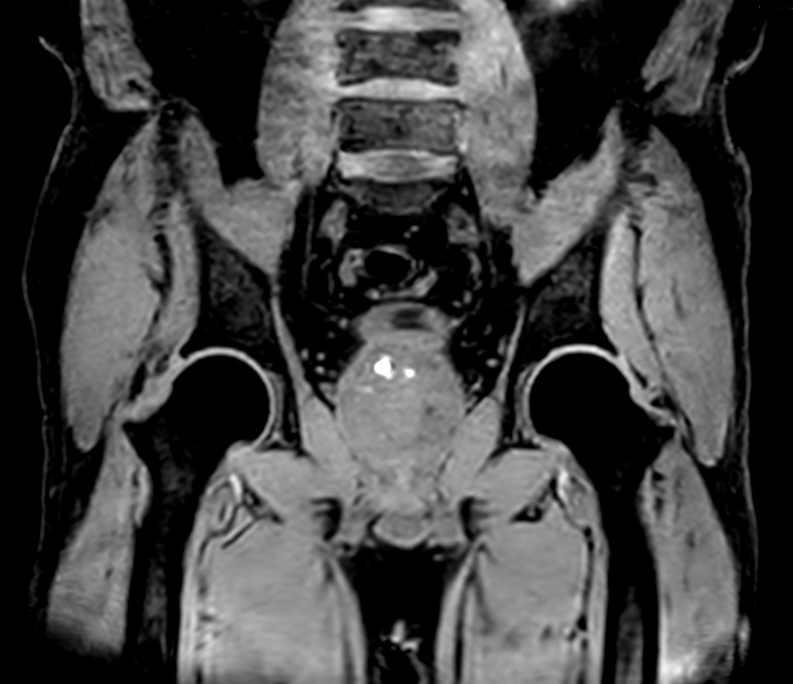 Multi Phase Contrast Enhanced Prostate Imaging Philips Mr Body Map