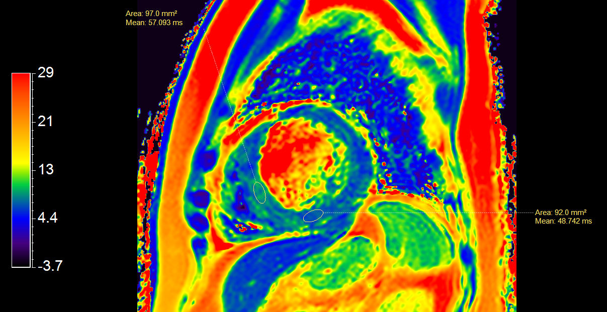 Myocardial Infarction With T1 T2 Mapping Philips Mr Body Map