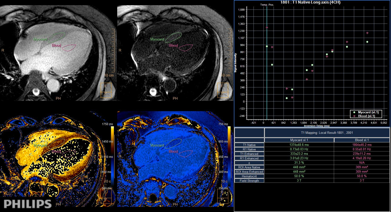 Myocardial Infarction With T1 T2 Mapping Philips Mr Body Map