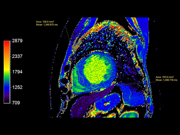 Myocardial infarction with T1/T2 Mapping | Philips MR Body Map Myocardial infarction with T1/T2 Mapping | Philips MR Body Map