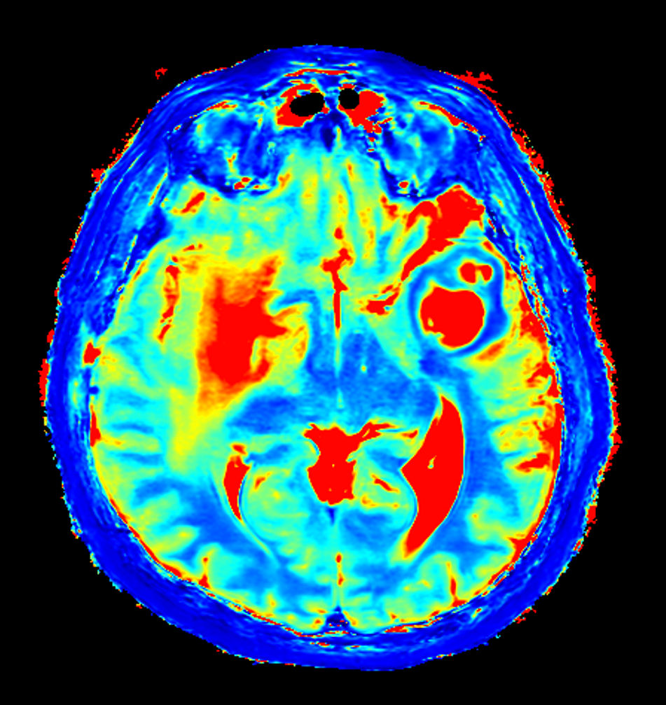 Large Lesion Brain Imaging With Synthetic Mri Philips Mr Body Map