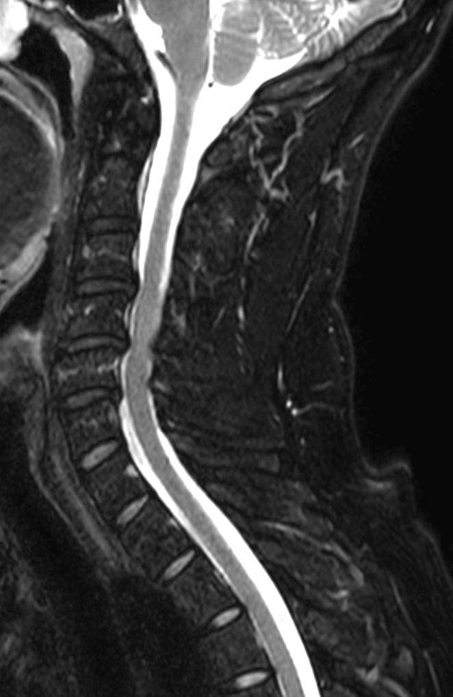 Cervical Spine With Mdixon Xd Philips Mr Body Map