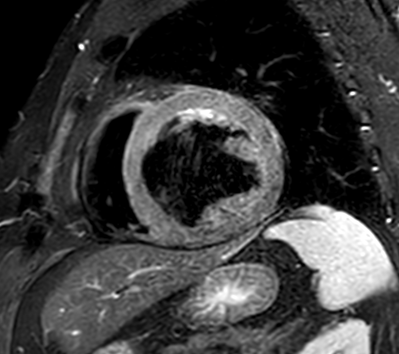 Cardiac Infarction With Compressed Sense Philips Mr Body Map