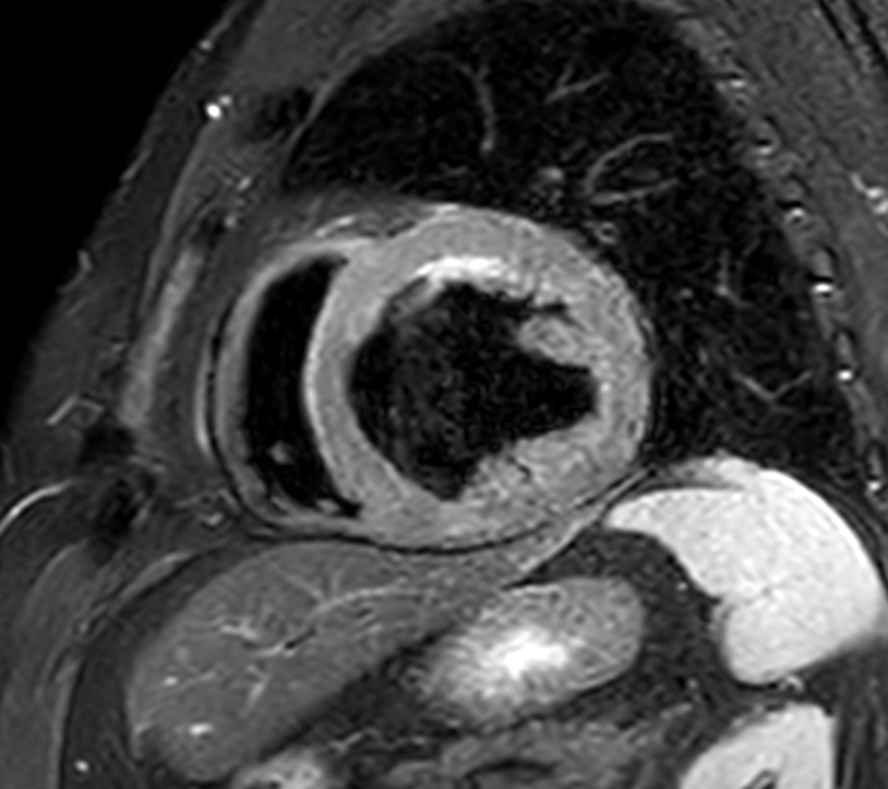 Cardiac Infarction With Compressed Sense Philips Mr Body Map