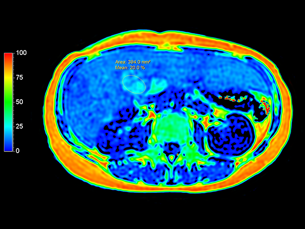 Mdixon Quant Steatosis Philips Mr Body Map