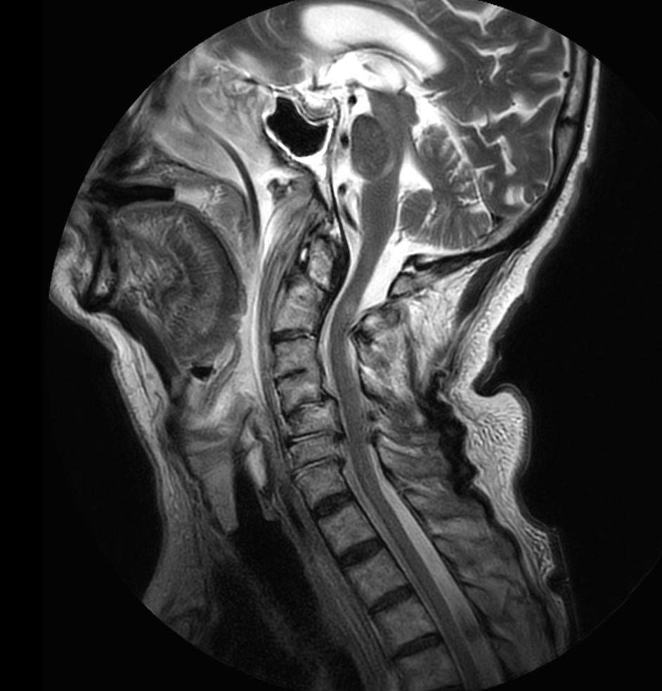 Cervical Spine Cord Lesion Philips Mr Body Map