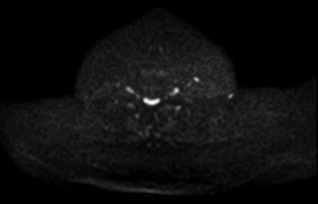 Comprehensive Cervical Spine Imaging At 3 0t Philips Mr Body Map