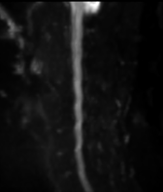 Comprehensive Cervical Spine Imaging At 3 0t Philips Mr Body Map