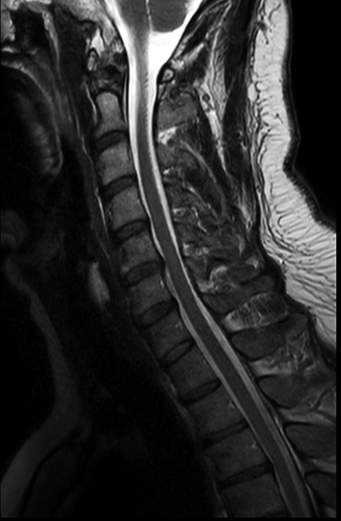 Comprehensive Cervical Spine Imaging At 3 0t Philips Mr Body Map