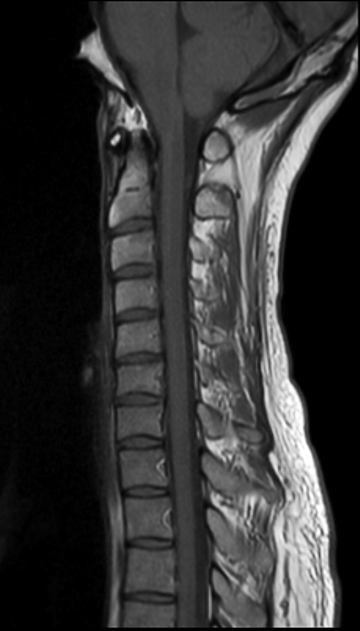 Cervical Spine Imaging With Mdixon Tse Philips Mr Body Map