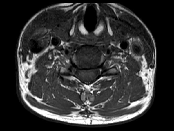 Cervical Spine Imaging With Mdixon Tse Philips Mr Body Map