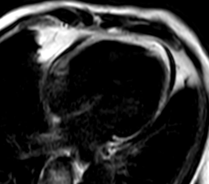 Cardiac Infarction With Fat Free Mdixon Imaging Philips Mr Body Map