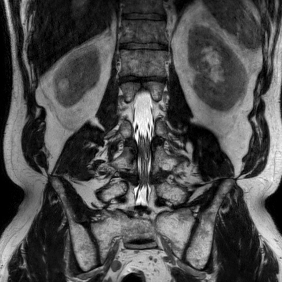 Lumbar Spine Disc Herniation Philips Mr Body Map