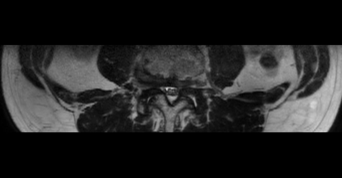 Lumbar Spine Disc Herniation Philips Mr Body Map
