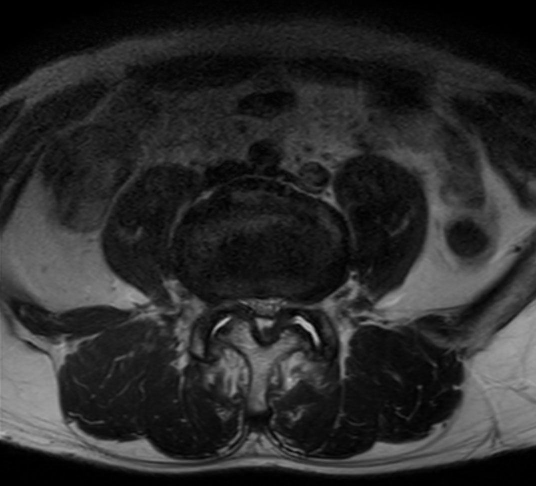 Lumbar Spine Disc Herniation Philips Mr Body Map