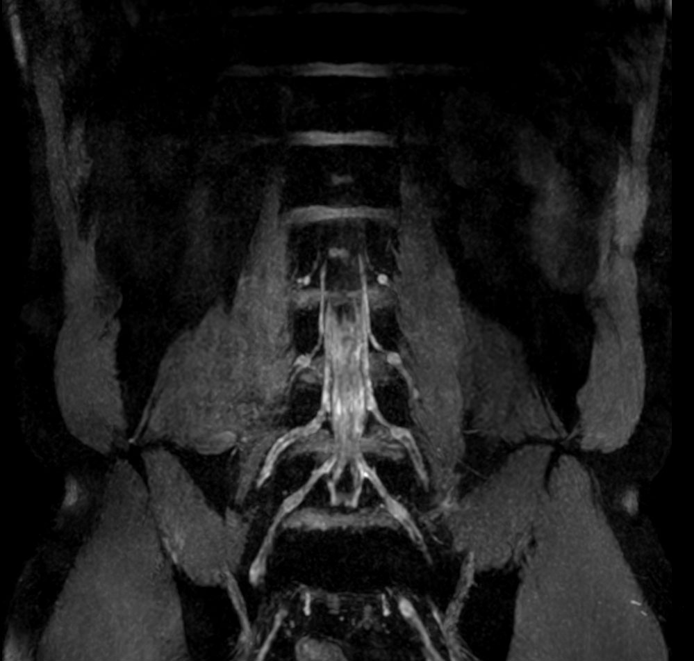 Lumbar Spine Disc Herniation Philips Mr Body Map