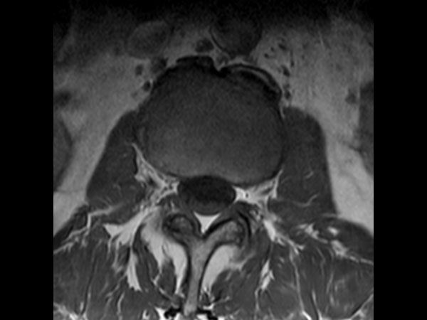 Comprehensive Lumbar Spine Imaging At 3 0t Philips Mr Body Map