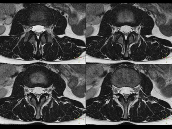 Comprehensive Lumbar Spine Imaging At 1 5t Philips Mr Body Map