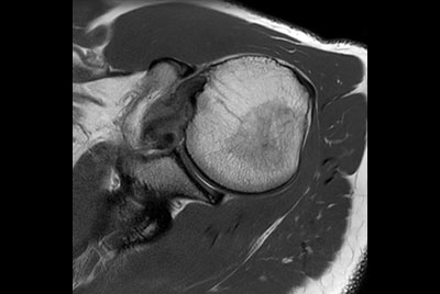 Shoulder imaging with the dS 16ch Shoulder coil | Philips MR Body Map