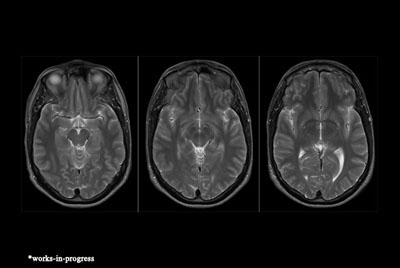 Brain imaging with MultiVane XD | Philips MR Body Map